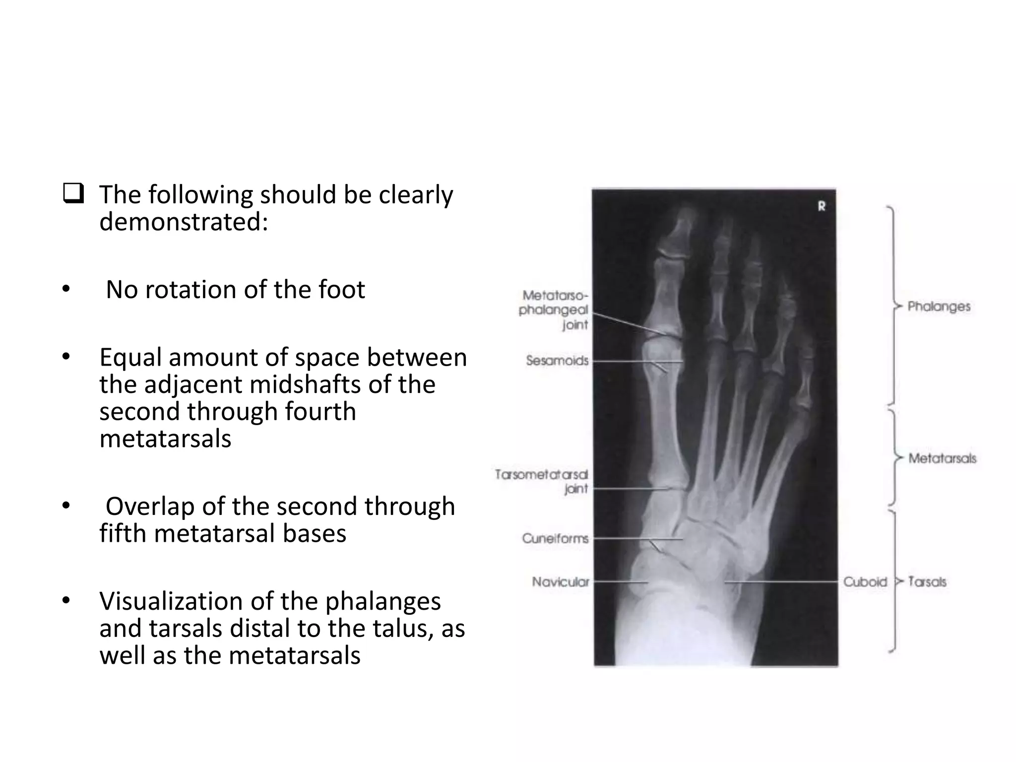 X ray of foot and ankle | PPTX