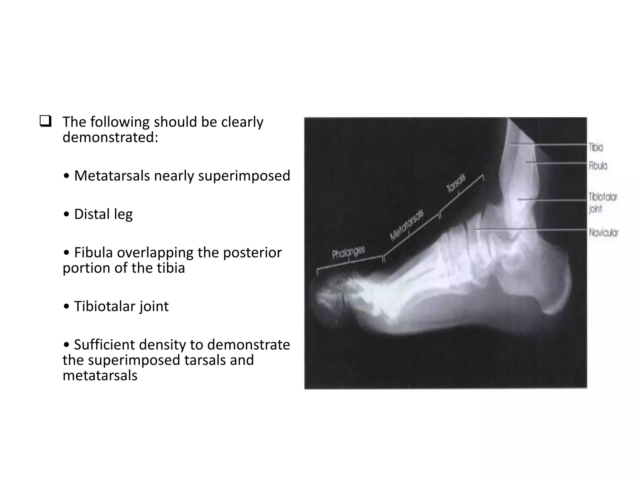 X ray of foot and ankle | PPTX
