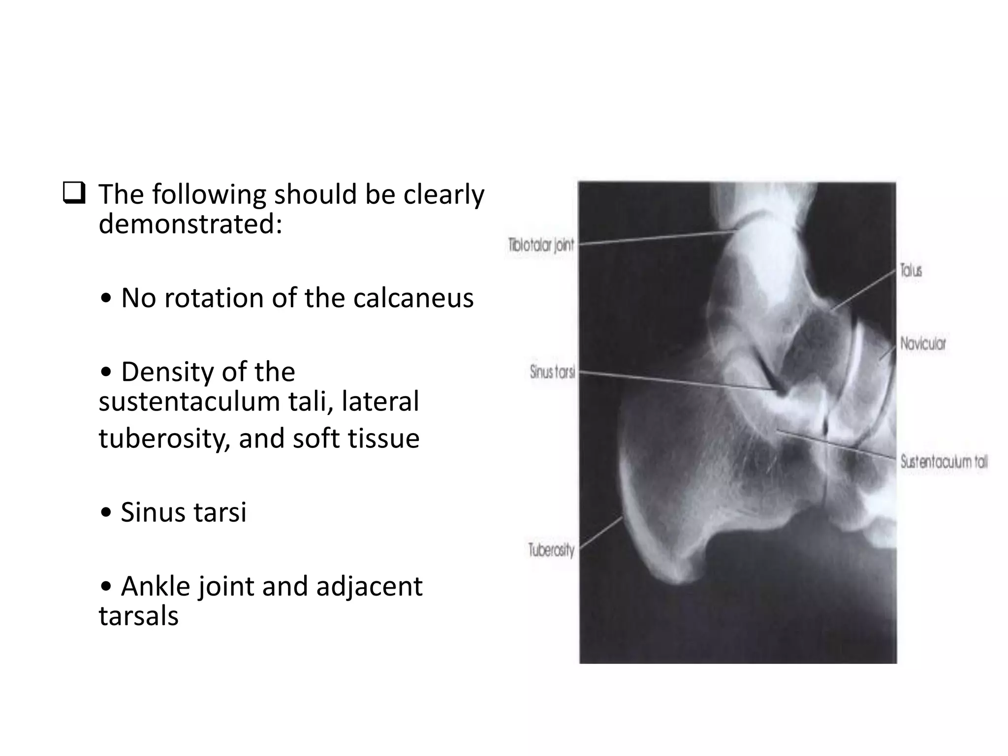 X ray of foot and ankle | PPTX