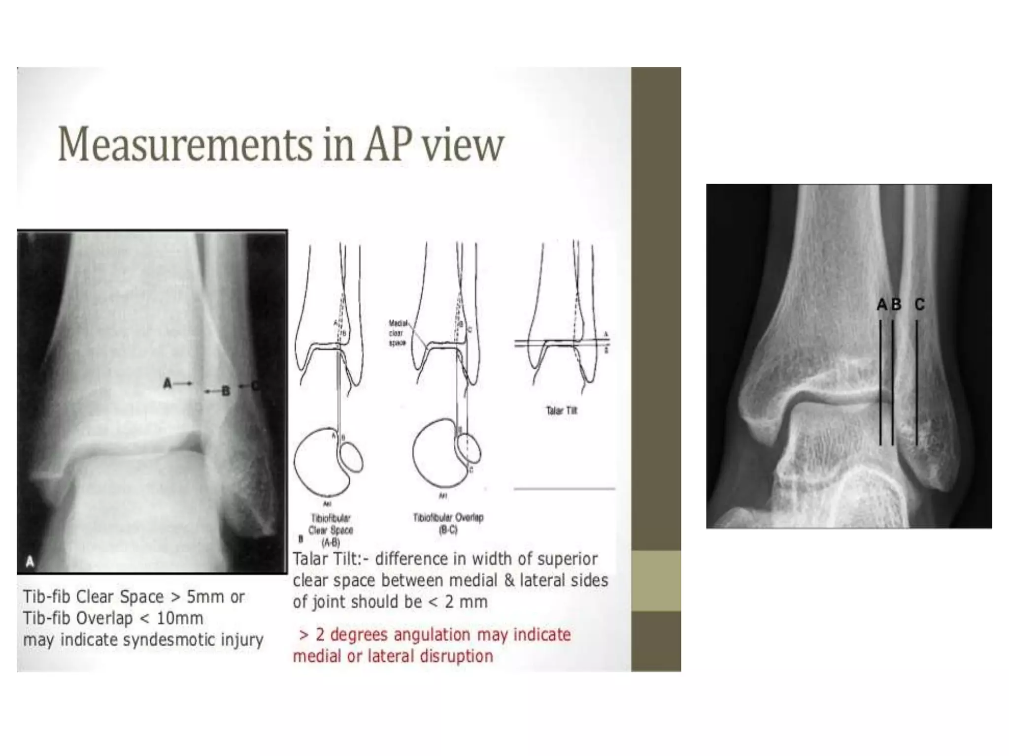 X ray of foot and ankle | PPTX