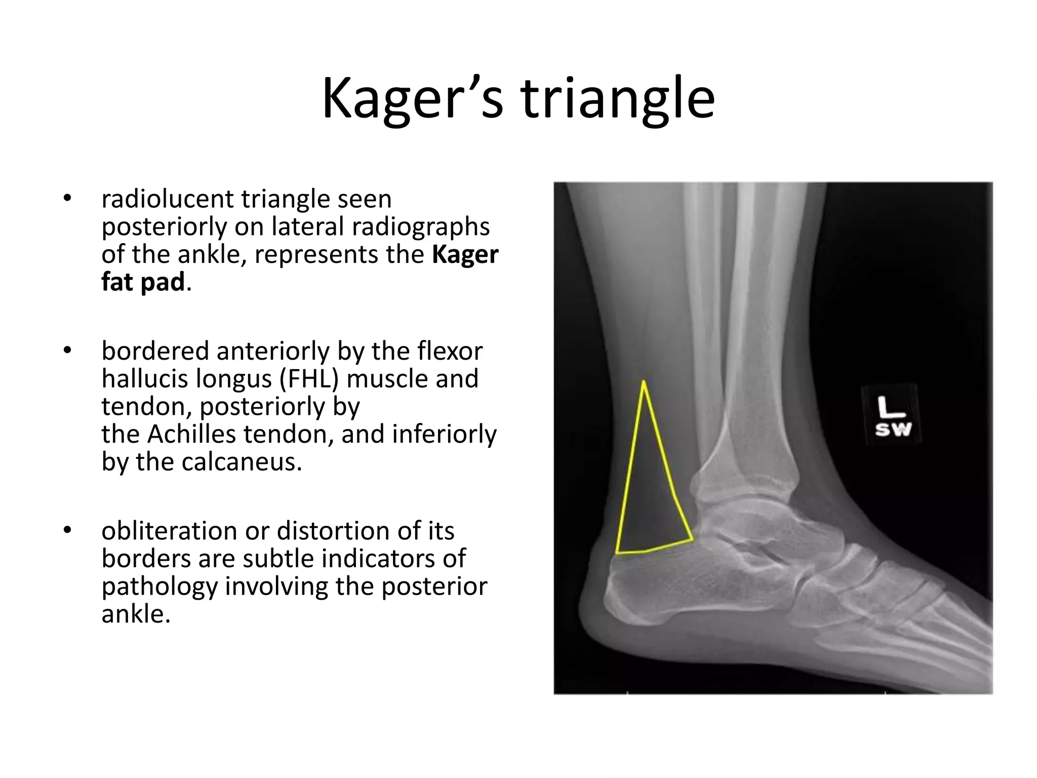 X ray of foot and ankle | PPTX