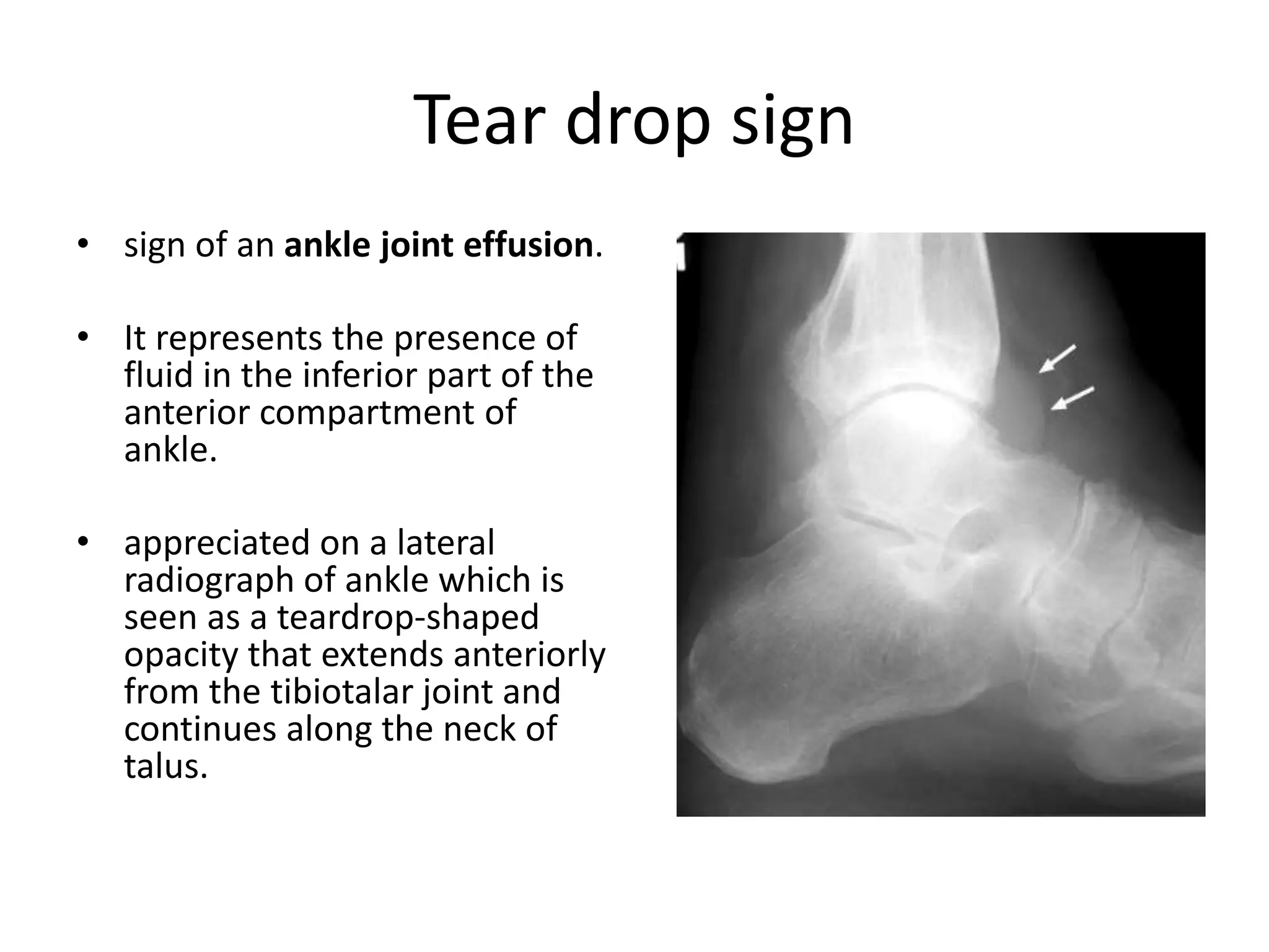 X ray of foot and ankle | PPTX