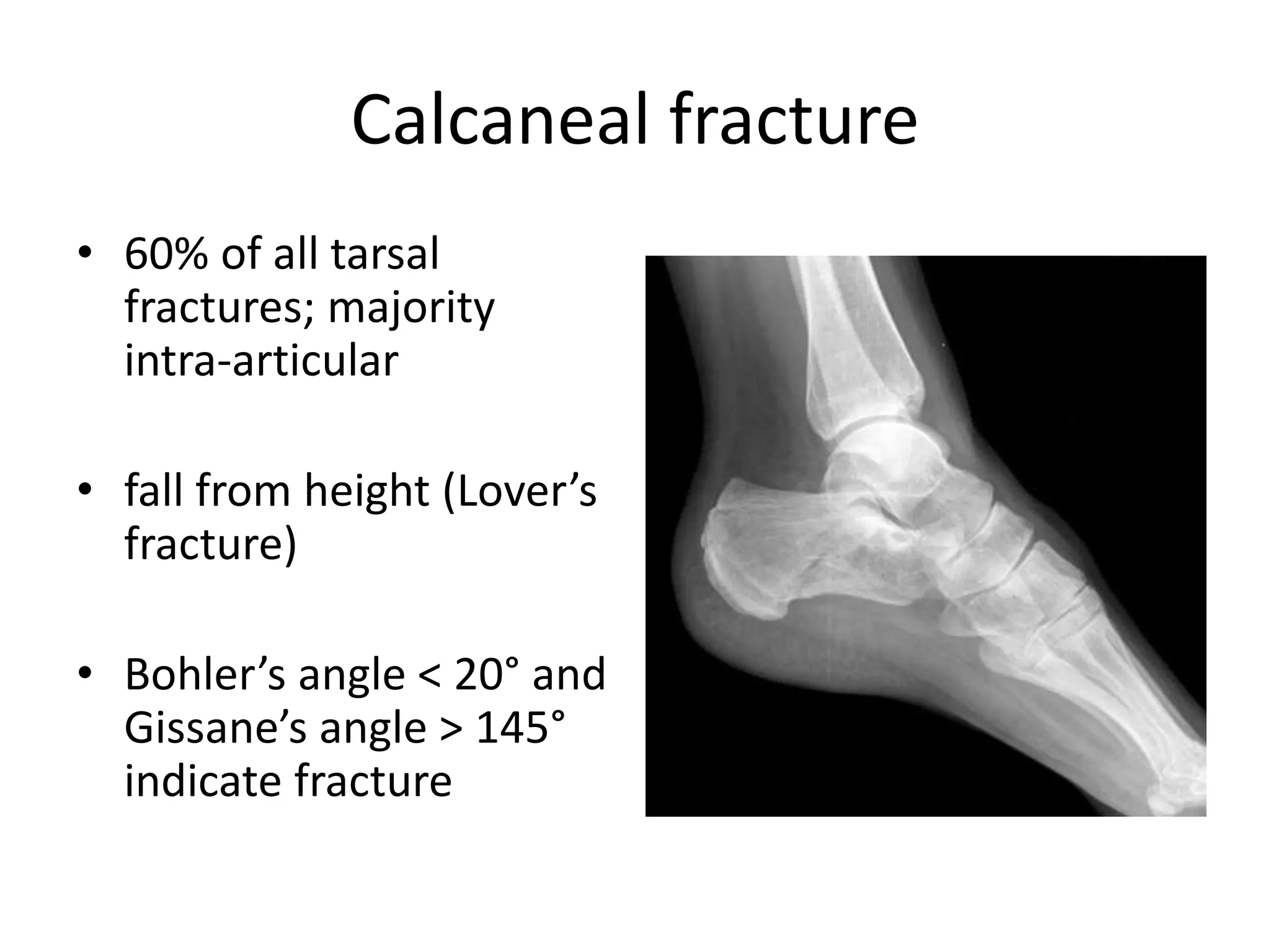 X ray of foot and ankle | PPTX