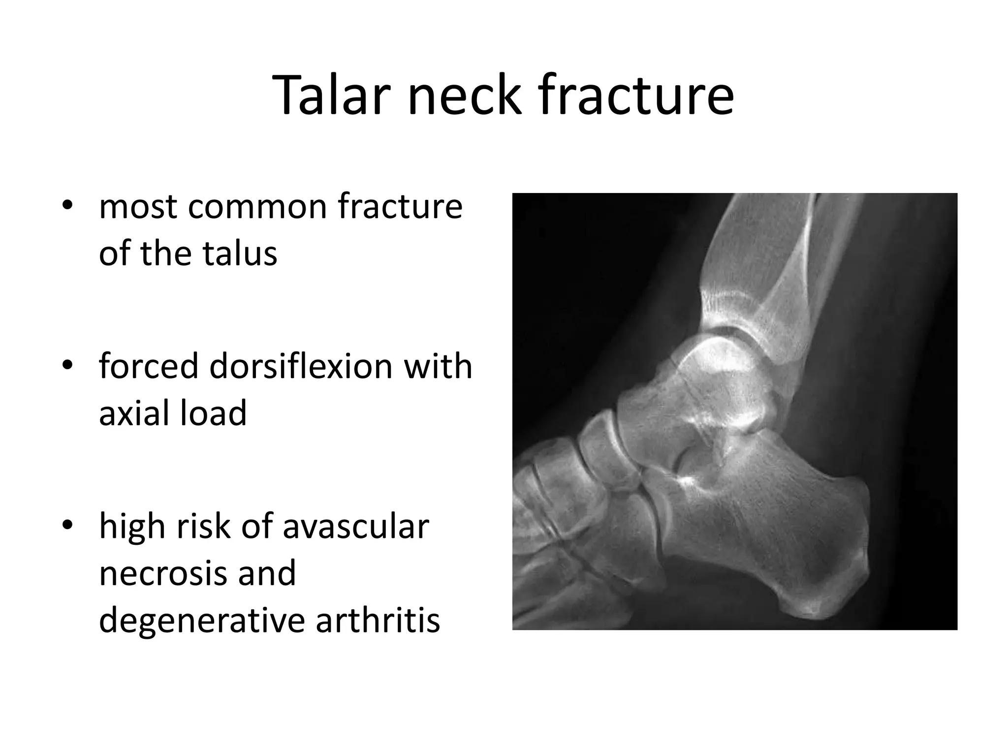 X ray of foot and ankle | PPTX