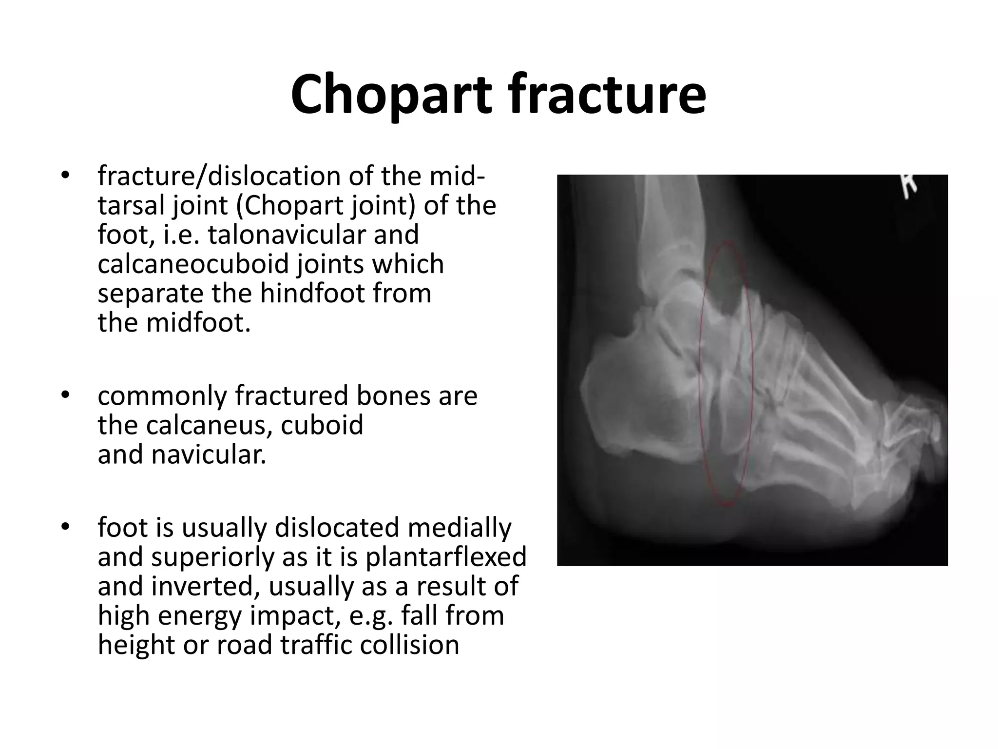 X ray of foot and ankle | PPTX