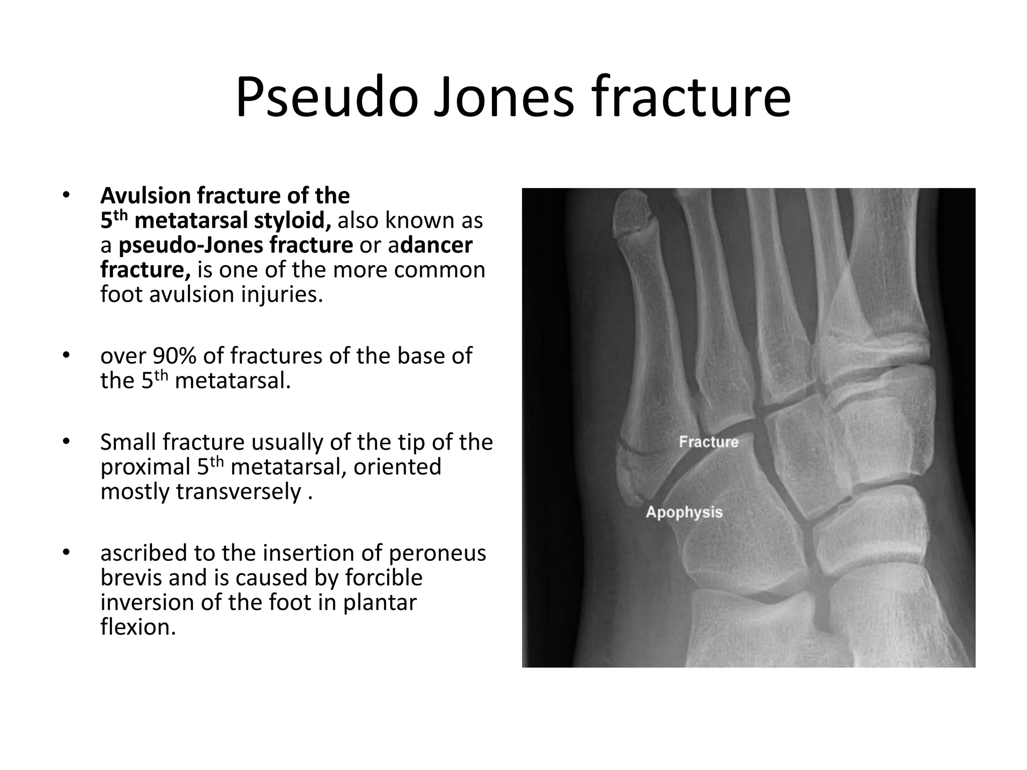 X ray of foot and ankle | PPTX
