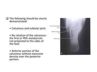 X ray of foot and ankle | PPTX