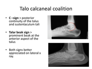 X ray of foot and ankle | PPTX