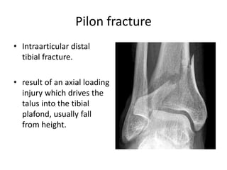 X ray of foot and ankle | PPTX