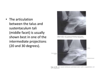 Sustentaculum Tali X Ray