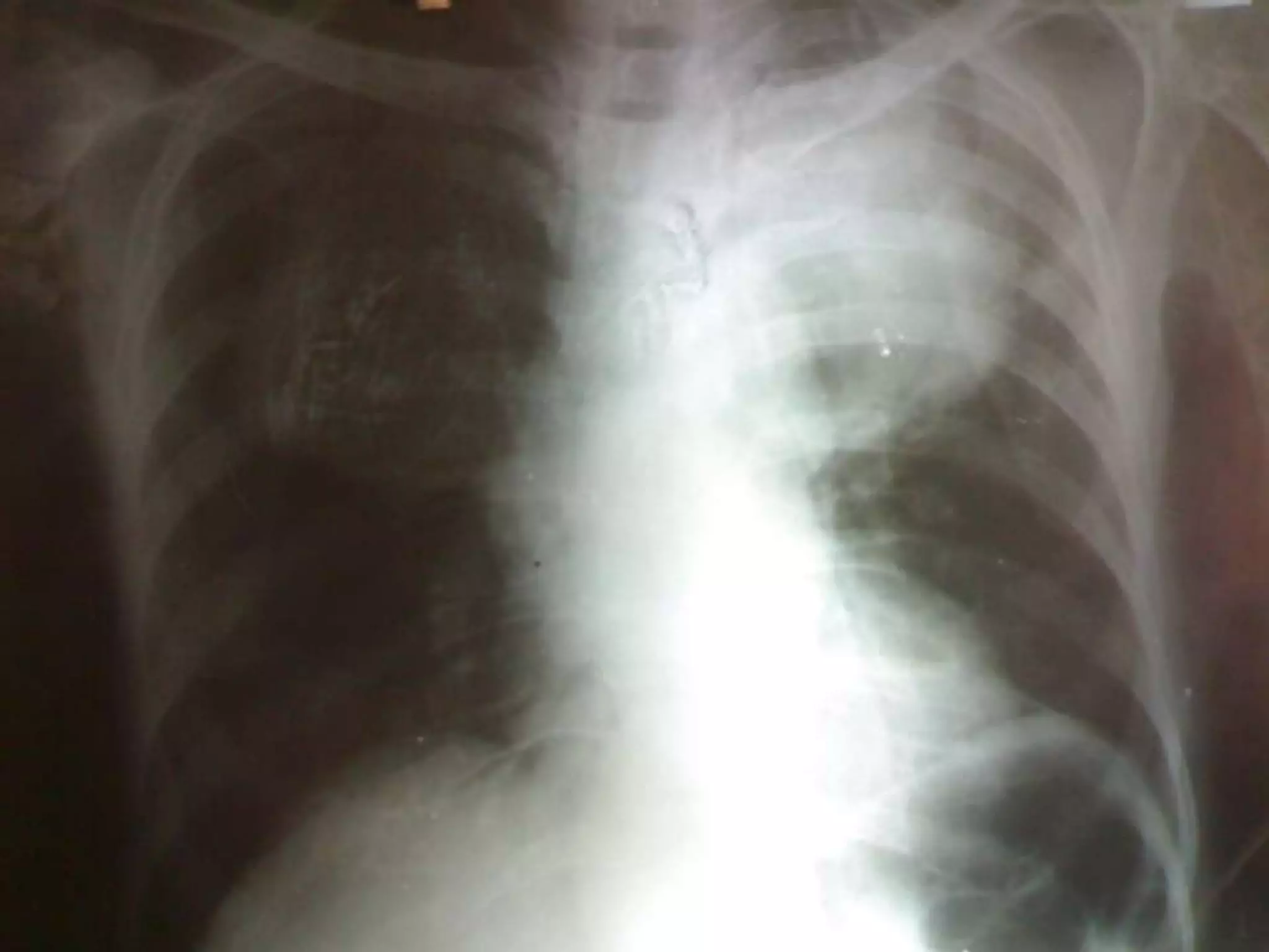 X Ray: Chest-Homogenous opacity | PPTX