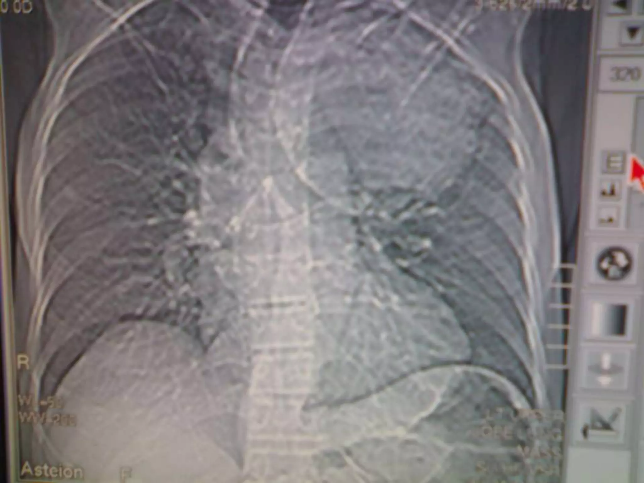 X Ray: Chest-Homogenous opacity | PPTX