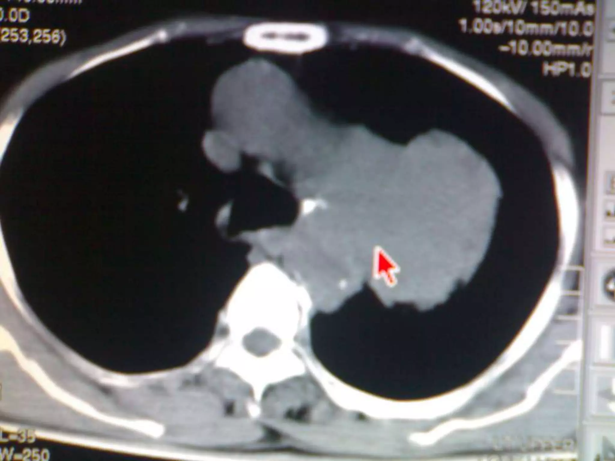 X Ray: Chest-Homogenous opacity | PPTX