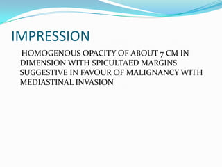 X Ray: Chest-Homogenous opacity | PPTX