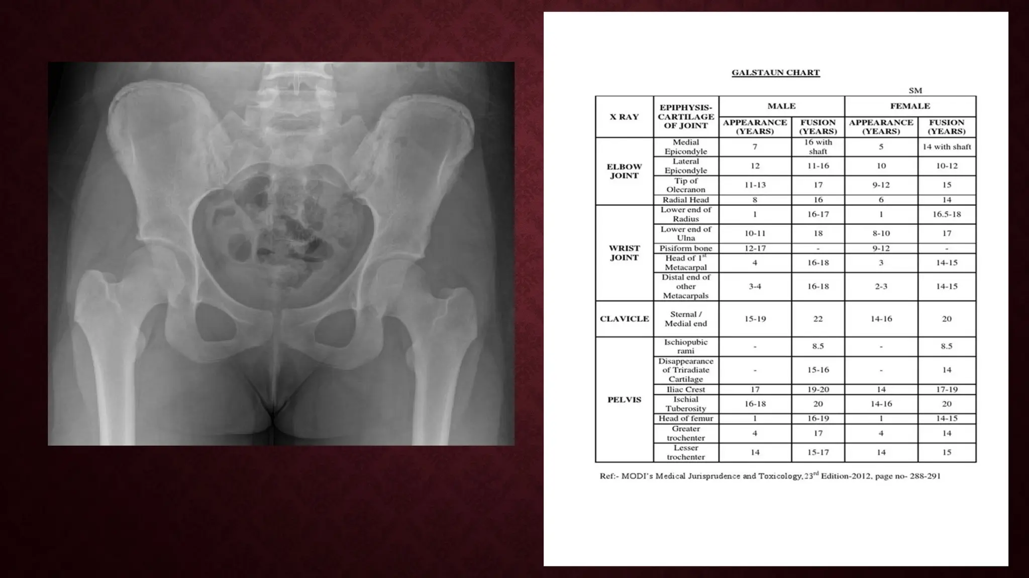 Skiagram pelvis age estimation slide forensic medicine | PPT