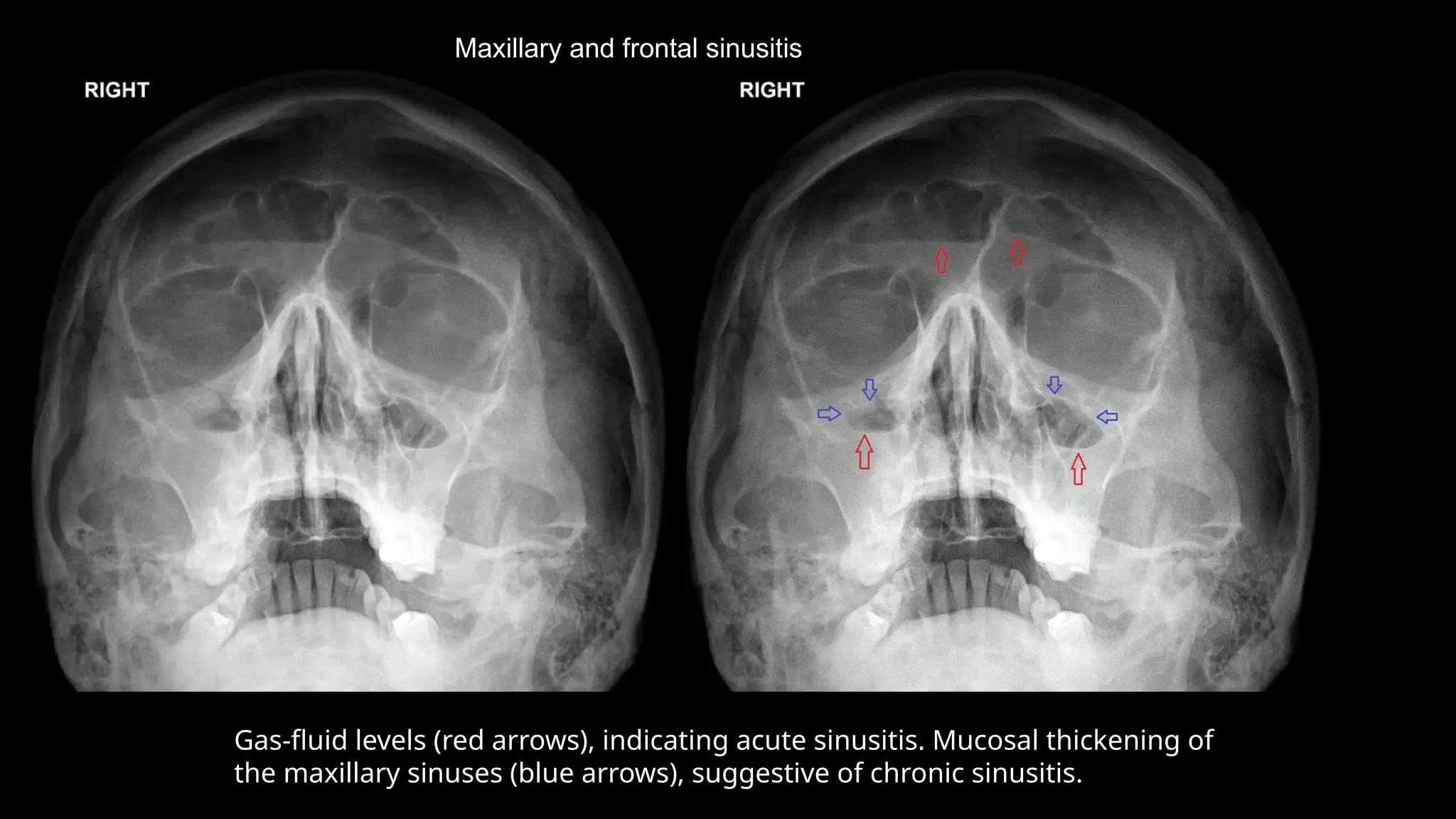 X ray Paranasal sinuses? PNS............ | PPTX