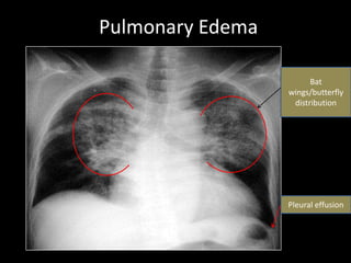 Pulmonary Edema X Ray Butterfly Pattern