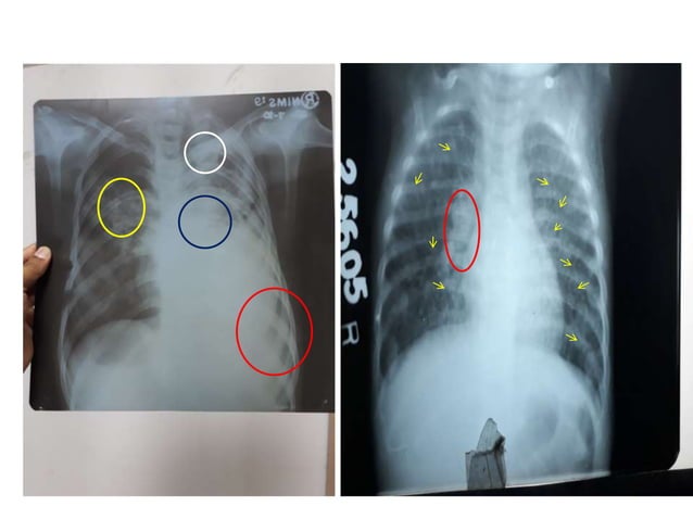 X rays in pediatrics | PPTX | Heart and Cardiovascular Diseases | Diseases and Conditions
