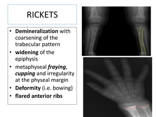 X rays in pediatrics | PPTX