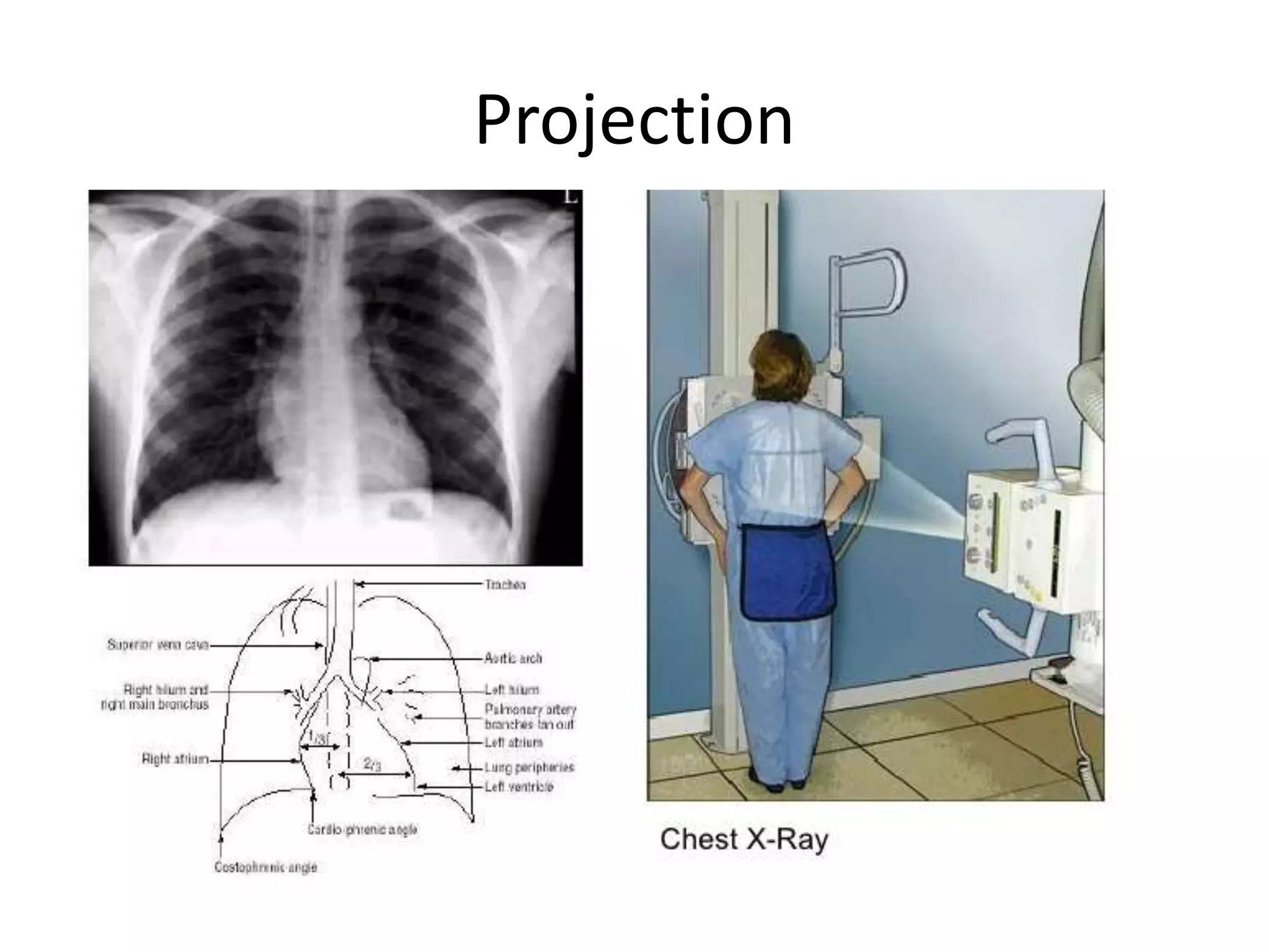 X Rays: chest injury, abdomen- bowel obstruction & perforation, KUB ...