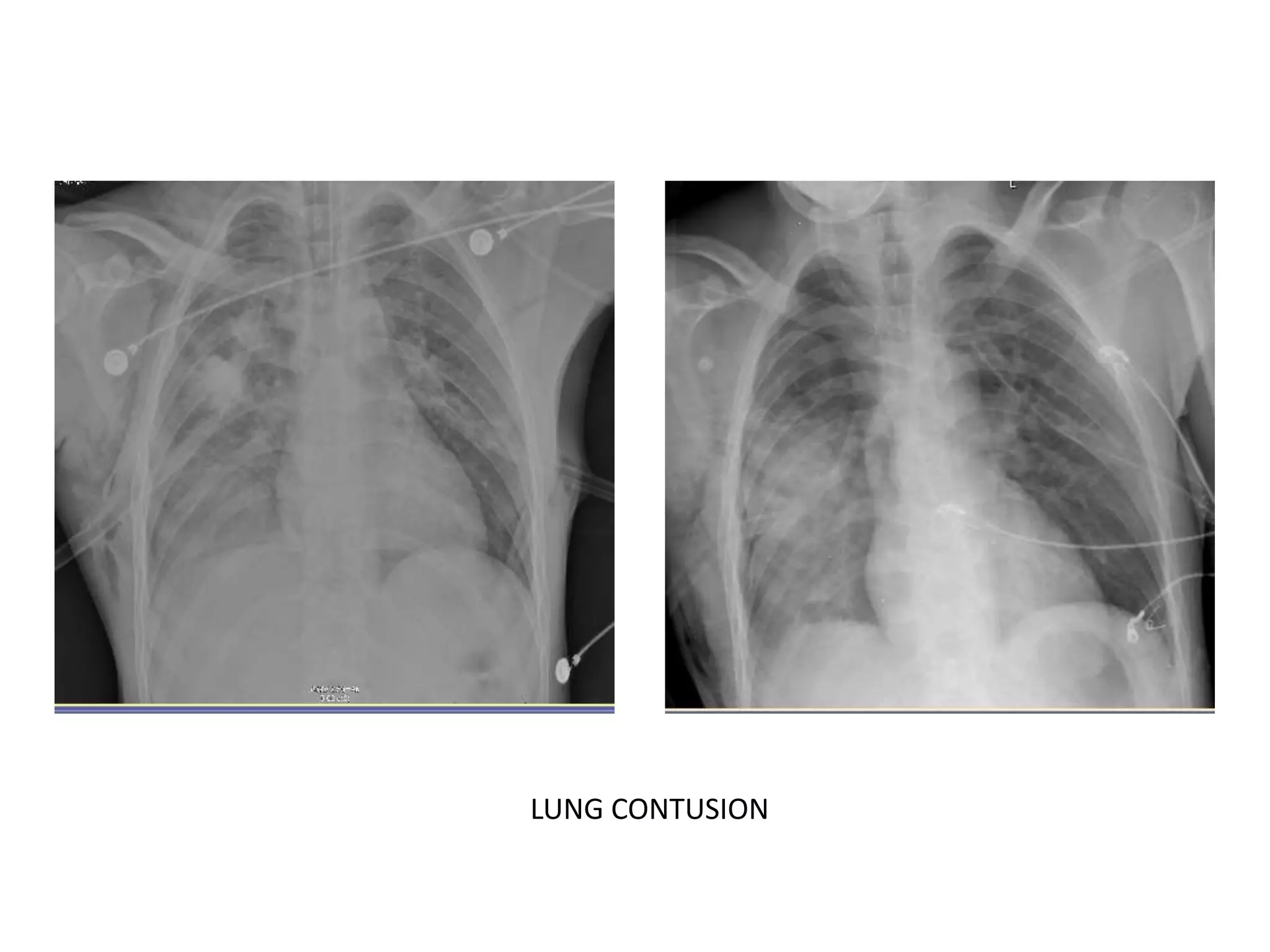 X Rays: chest injury, abdomen- bowel obstruction & perforation, KUB ...