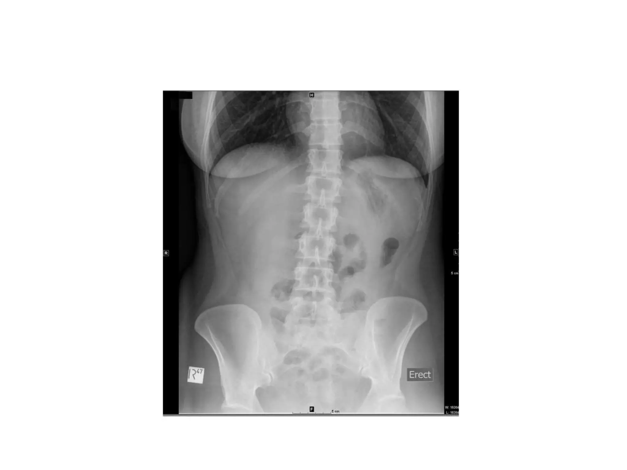 X Rays: chest injury, abdomen- bowel obstruction & perforation, KUB ...