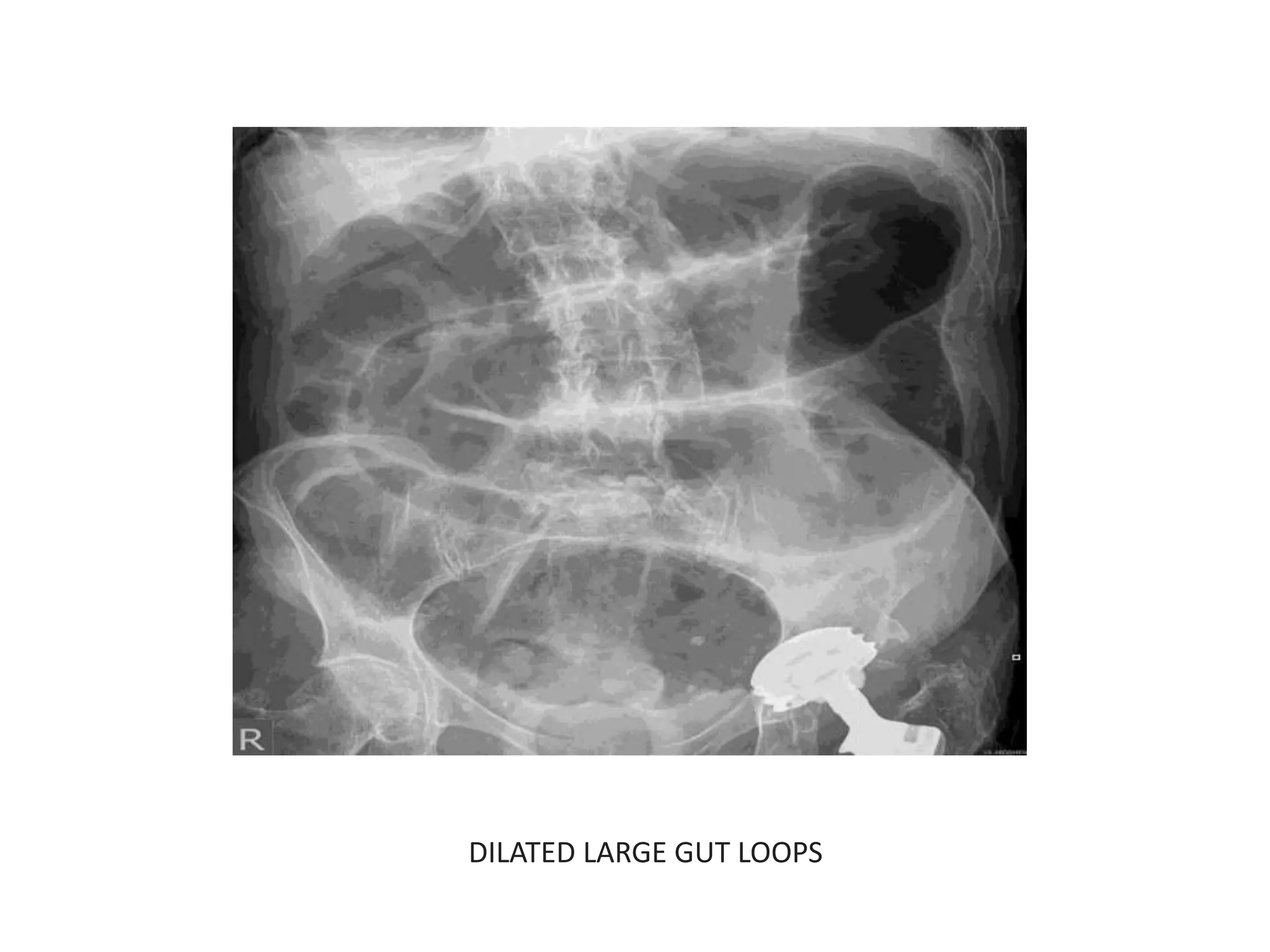 X Rays: chest injury, abdomen- bowel obstruction & perforation, KUB ...