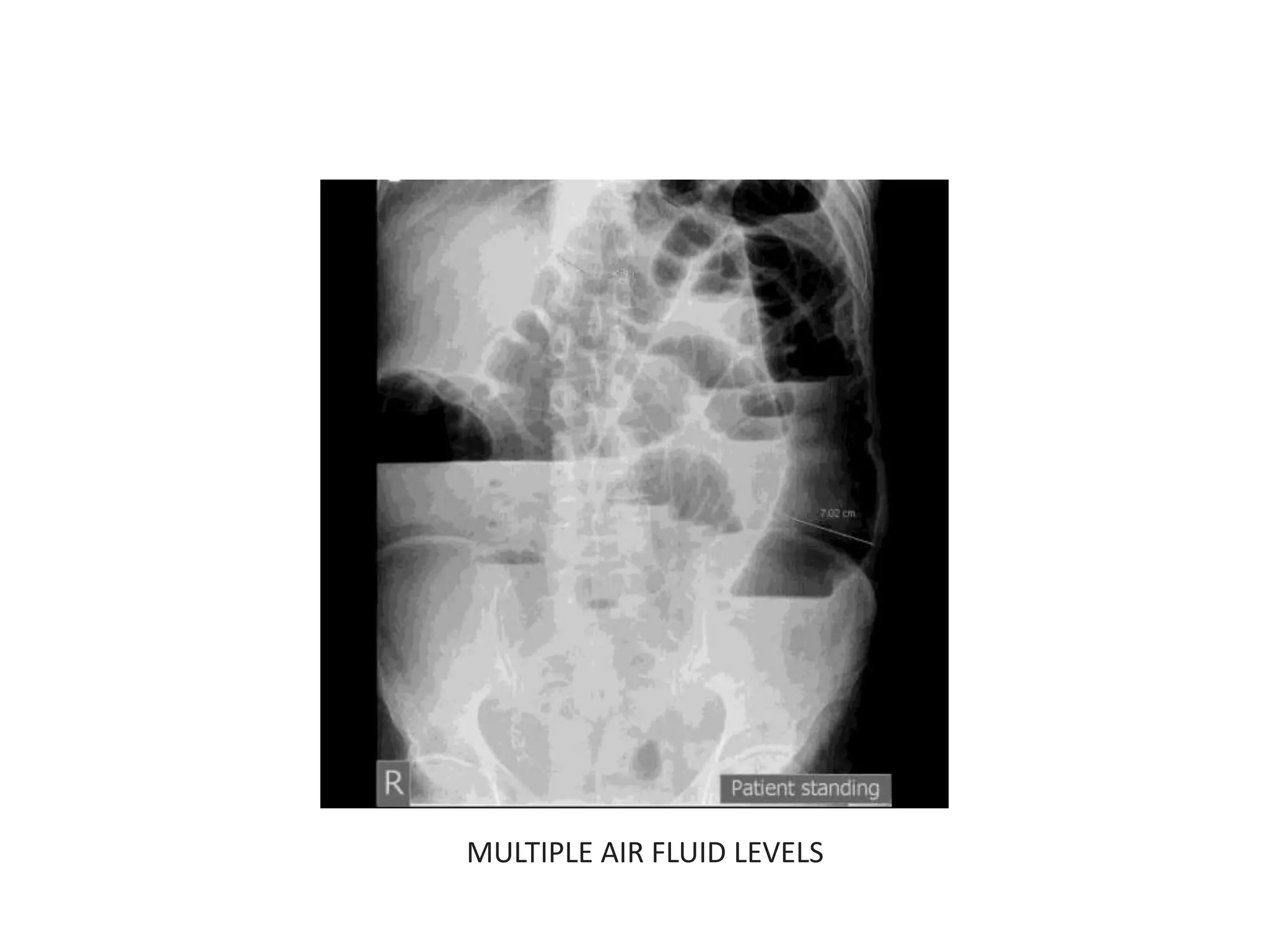 X Rays: chest injury, abdomen- bowel obstruction & perforation, KUB ...