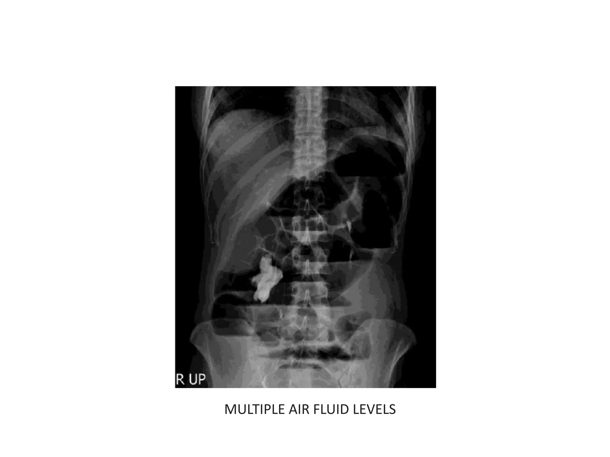 X Rays: chest injury, abdomen- bowel obstruction & perforation, KUB ...
