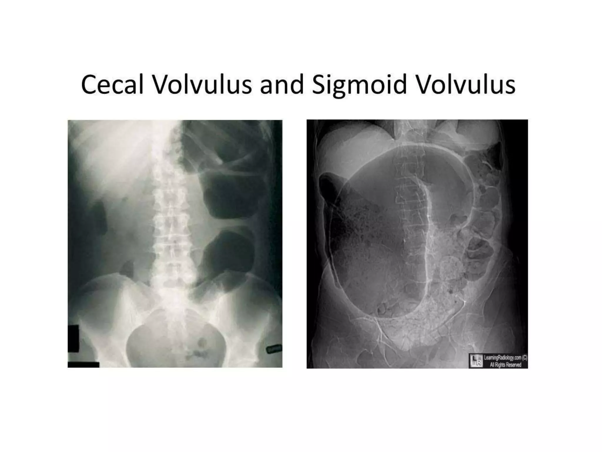 X Rays: chest injury, abdomen- bowel obstruction & perforation, KUB ...