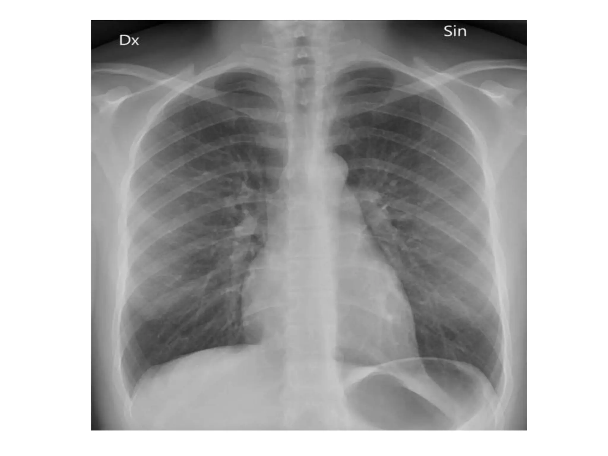 X Rays: chest injury, abdomen- bowel obstruction & perforation, KUB ...
