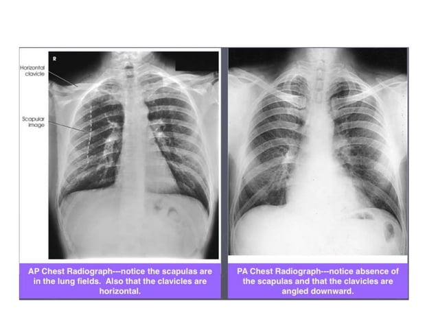 X Rays: chest injury, abdomen- bowel obstruction & perforation, KUB ...