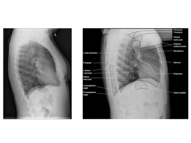 X Rays: chest injury, abdomen- bowel obstruction & perforation, KUB ...