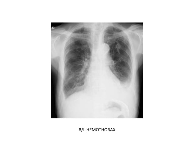 X Rays: chest injury, abdomen- bowel obstruction & perforation, KUB ...