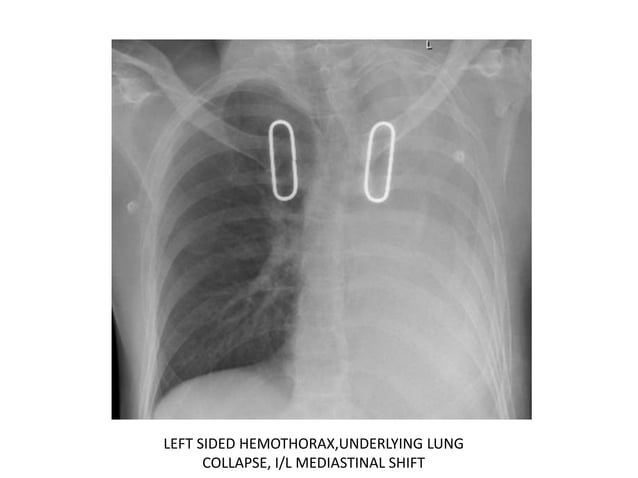 X Rays: chest injury, abdomen- bowel obstruction & perforation, KUB ...