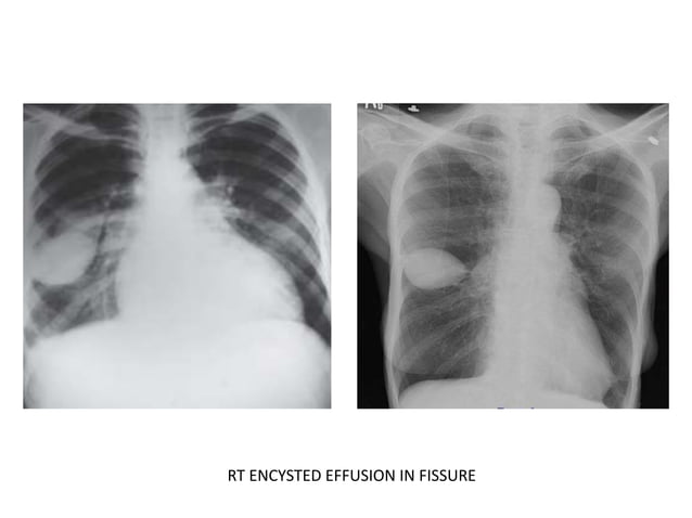 X Rays: chest injury, abdomen- bowel obstruction & perforation, KUB ...