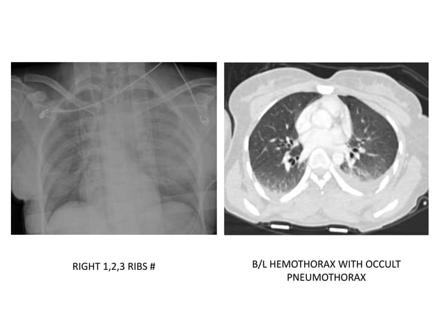 X Rays: chest injury, abdomen- bowel obstruction & perforation, KUB ...