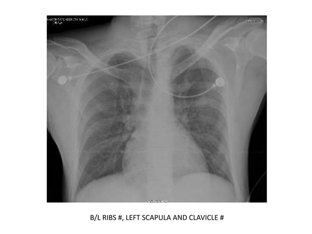 X Rays: chest injury, abdomen- bowel obstruction & perforation, KUB ...