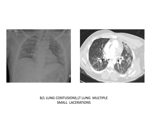 X Rays: chest injury, abdomen- bowel obstruction & perforation, KUB ...