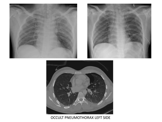 X Rays: chest injury, abdomen- bowel obstruction & perforation, KUB ...