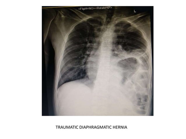 X Rays: chest injury, abdomen- bowel obstruction & perforation, KUB ...