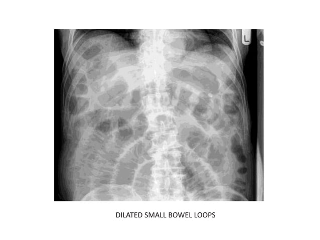 X Rays: chest injury, abdomen- bowel obstruction & perforation, KUB ...