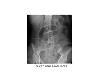 X Rays: chest injury, abdomen- bowel obstruction & perforation, KUB ...