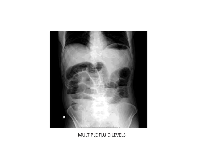 X Rays: chest injury, abdomen- bowel obstruction & perforation, KUB ...