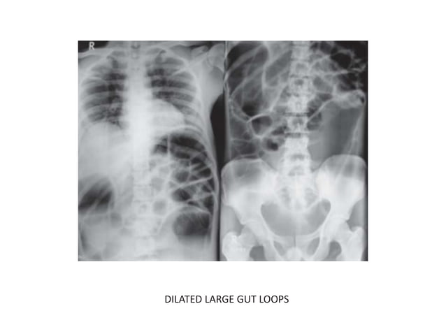 X Rays: chest injury, abdomen- bowel obstruction & perforation, KUB ...