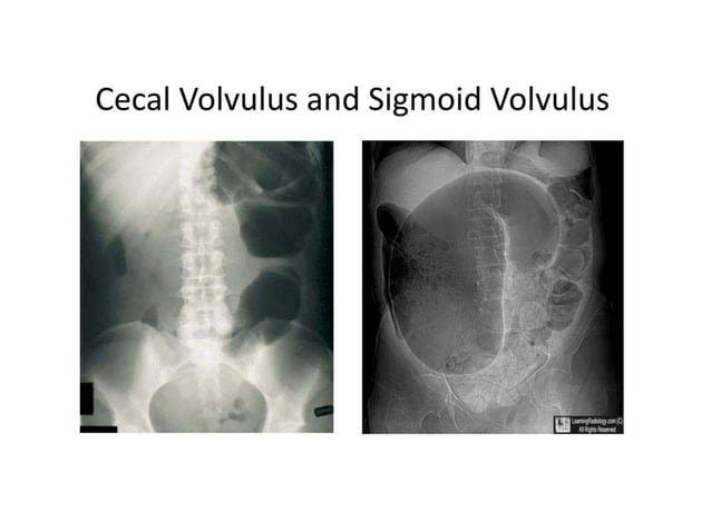 X Rays: chest injury, abdomen- bowel obstruction & perforation, KUB ...