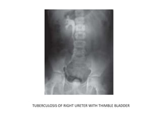 X Rays: chest injury, abdomen- bowel obstruction & perforation, KUB ...