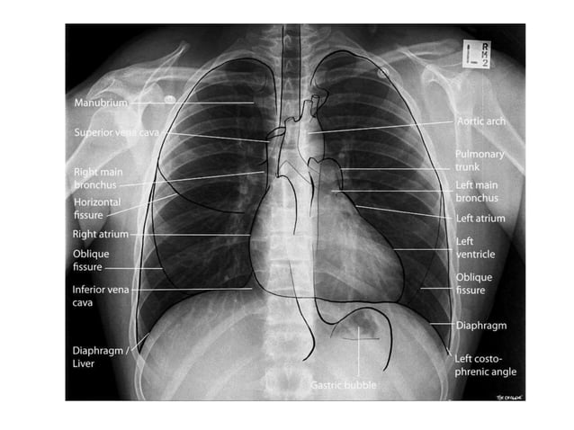 X Rays: chest injury, abdomen- bowel obstruction & perforation, KUB ...