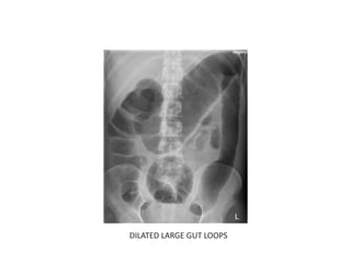 X Rays: chest injury, abdomen- bowel obstruction & perforation, KUB ...