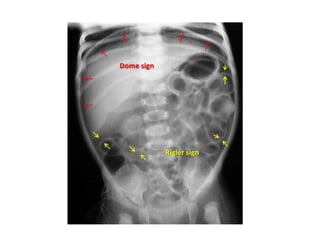 X Rays: chest injury, abdomen- bowel obstruction & perforation, KUB ...